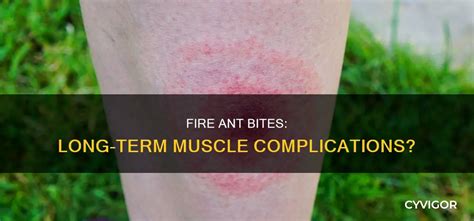 Fire Ant Bites Long Term Muscle Complications Cyvigor