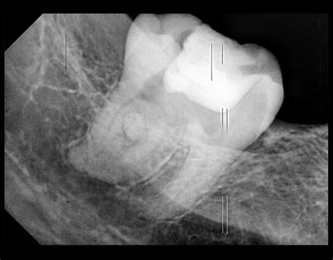 Using Imaging To Help Treat A Fused Wisdom Tooth