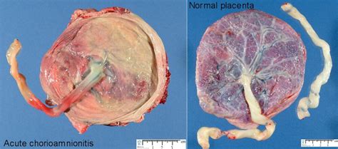 Acute Chorioamnionitis Human Pathology Photos Pictures Videos