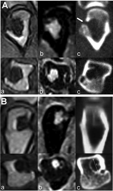 Caveat On The Interpretation Of Metacarpal Head Erosions Seen By