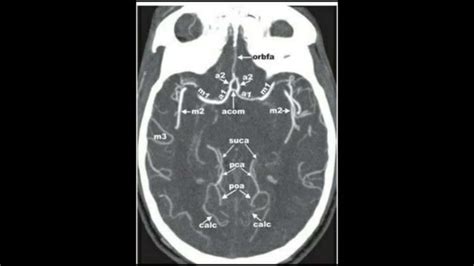 Ct Angio 2pptx By Sms Medical College Jaipur Ppt