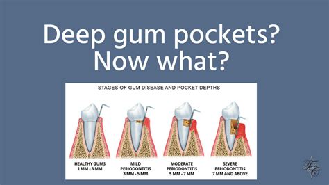 What Are Dental Pockets At Thomas Moose Blog