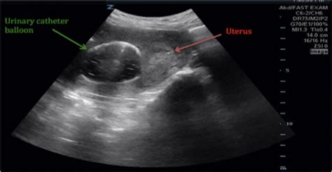 Use Of Point Of Care Ultrasound To Facilitate Guidance And Intrauterine