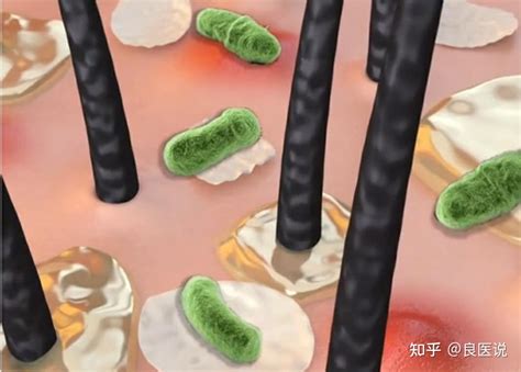 头屑越扣越多？可能是脂溢性皮炎！ 知乎