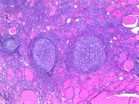 Hashimoto Thyroiditis He Staining 20× Magnification Download Scientific Diagram