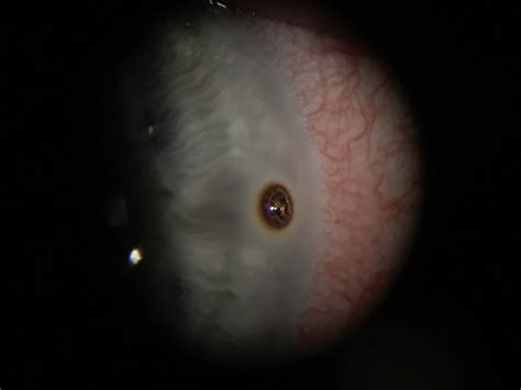 Corneal Rust Ring