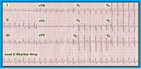 Supraventricular Tachycardia 네이버 블로그