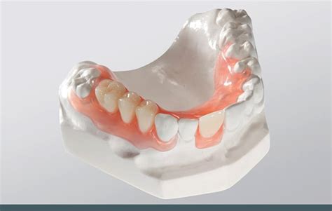 Lower Valplast Flexible Partial Qualitydentallab