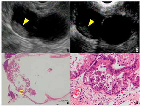 Definition Of Mural Nodule At Ashleigh Salvatore Blog