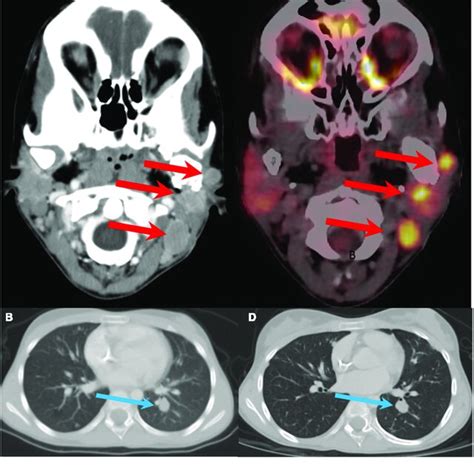Clear Cell Sarcoma Histology A Sox10 Positive Staining B Mart1