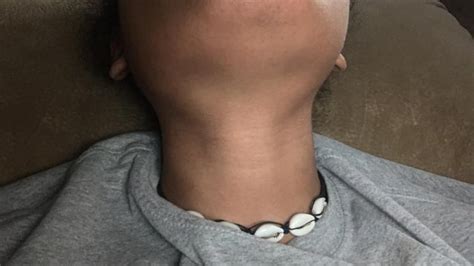 Lumps Under Jaw R Medical