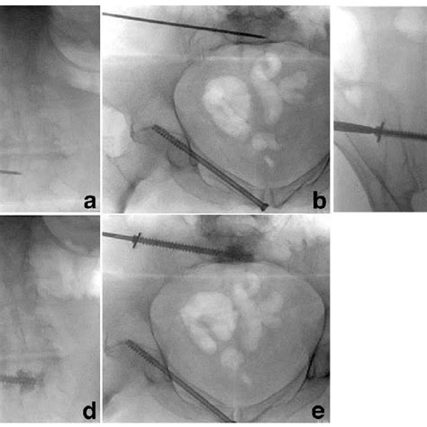 Classification Of Included Pelvic Ring Fractures According To Otaao