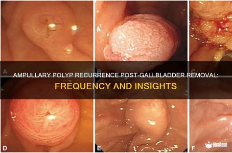 Ampullary Polyp Recurrence Post Gallbladder Removal Frequency And