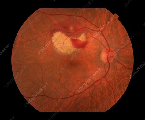 Retinal Artery Macroaneurysm Stock Image C0306979 Science Photo Library