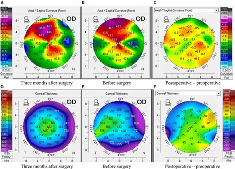 Corneal Topography Of Band Keratopathy Following Treatment Of