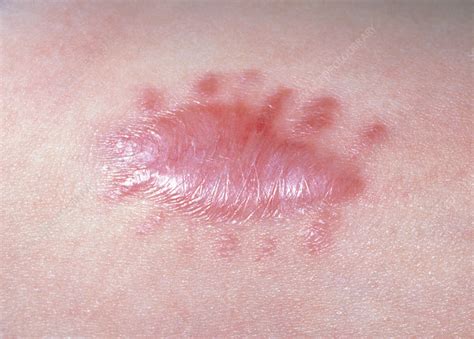Cartilage Keloid Symptoms Keloid Scars Signs And Symptoms Dybne