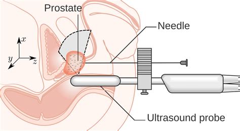 Schematic Representation Of A Typical Brachytherapy Procedure Download Scientific Diagram