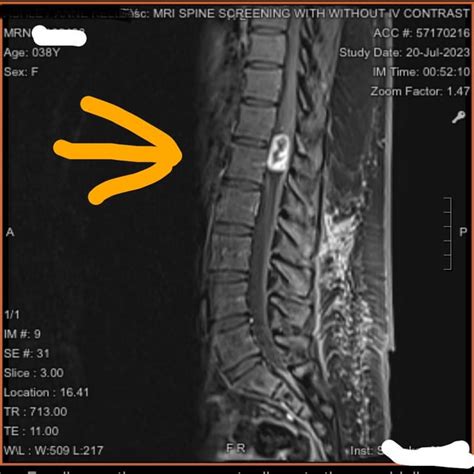 Severe Sciatica Symptoms But Clear X Rays And Mri Rsciatica