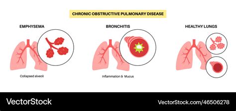 Chronic Obstructive Pulmonary Disease Royalty Free Vector