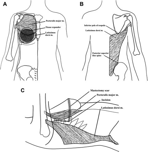 Schematic Of Relevant Anatomy Of The Latissimus Dorsi Flap For Breast