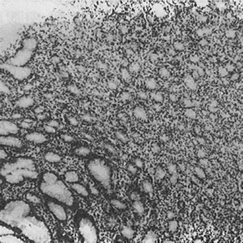 Neoplastic Lymphocytes Partially Infiltrating Gastric Mucosa Download Scientific Diagram