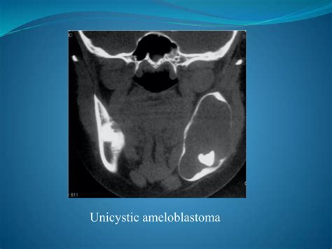 Ameloblastoma Pptx