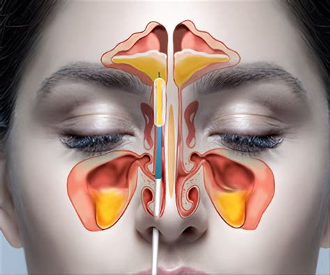 How To Breathe After Sinus Surgery At Eusebia Horton Blog