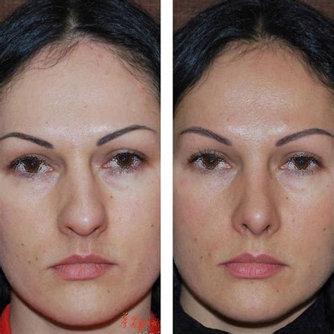 Surgery For Deviated Septum Rhinoplasty Cost Pics Reviews Qanda