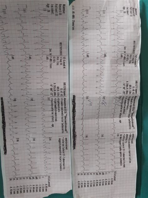 Posterior Stemi R Ekgs