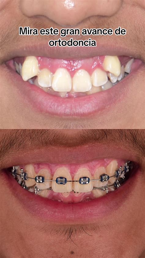 Dientes Antes Y Después De Los Brackets