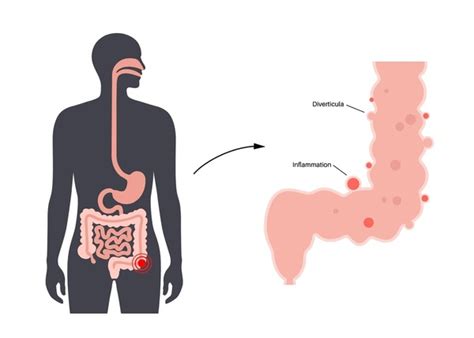 314 Digestive System Bleeding Vector Stock Vectors And Vector Art Shutterstock
