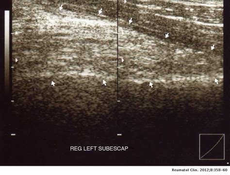 Elastofibroma Dorsi Review Of 4 Cases Reumatología Clínica English