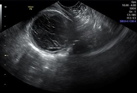 Hemorrhagic Ovarian Cyst Ultrasound
