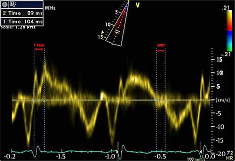 Tdi From The Beginning Of The Isovolumetric Contraction To The Peak Of