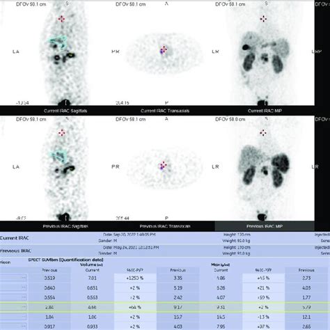 Comparison Between A Baseline And A Follow Up Scan Of A 69−year−old Download Scientific Diagram