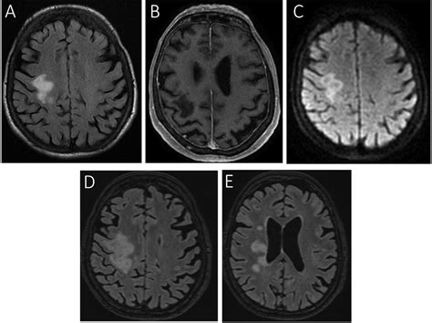 Progressive Multifocal Leukoencephalopathy Gross