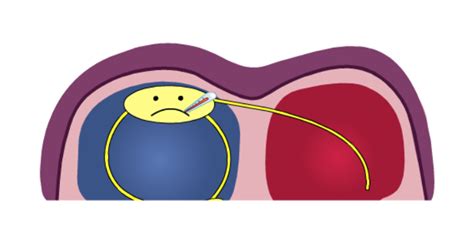 Sinus Block Arrest Key Learning Points Acls Certification Association
