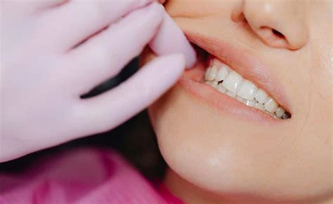 Profilaxis Dental Bastida Clínica Dental