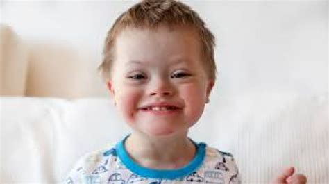Down Syndrome Types Physical Features