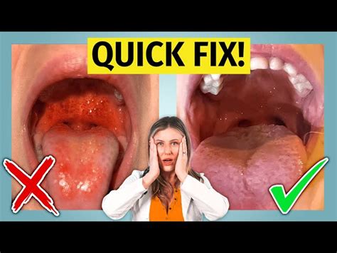 Severe Strep Throat Throat Infections Often Caused By Viruses Or