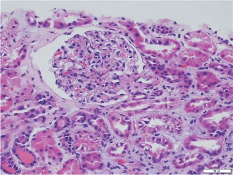 Glomerulus Without Mesangial Expansion Or Increased Cellularity Hande 20x