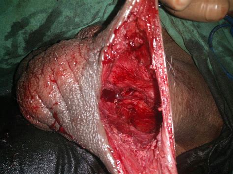 Dr Parthiv Sanghvi Successfully Operated On A Patient With A Large