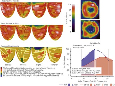 Subendocardial And Transmural Myocardial Ischemia Clinical Characteristics Prevalence And Subendocardial And Transmural Myocardial Ischemia Clinical Characteristics Prevalence And