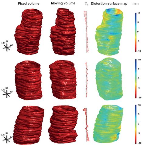 Example Distortion Maps Of Three Mri Studies A Showing Significant