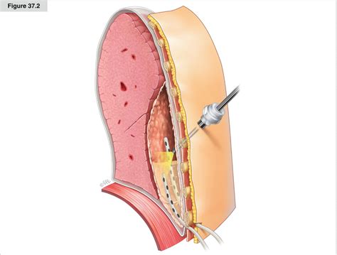 Pleural Empyema Thoracic Key