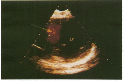 Upper Parasternal Short Axis View Of The Left Ventrcle In Patient 2