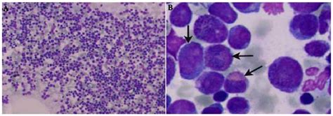 Bone Marrow Smear With Hypercellular Dysplastic Monocytes And Download Scientific Diagram