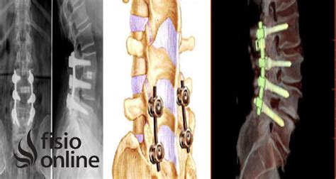 Artrodesis Qué Es Por Qué Se Realiza Contraindicacions
