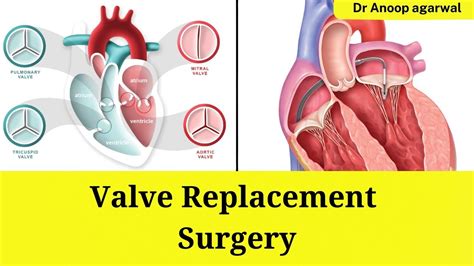 Heart Valve Replacement Surgery What You Need To Know Youtube