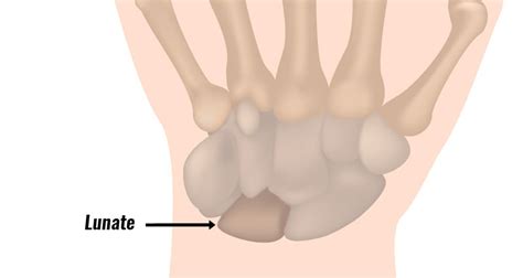 Triquetral Fracture Symptoms